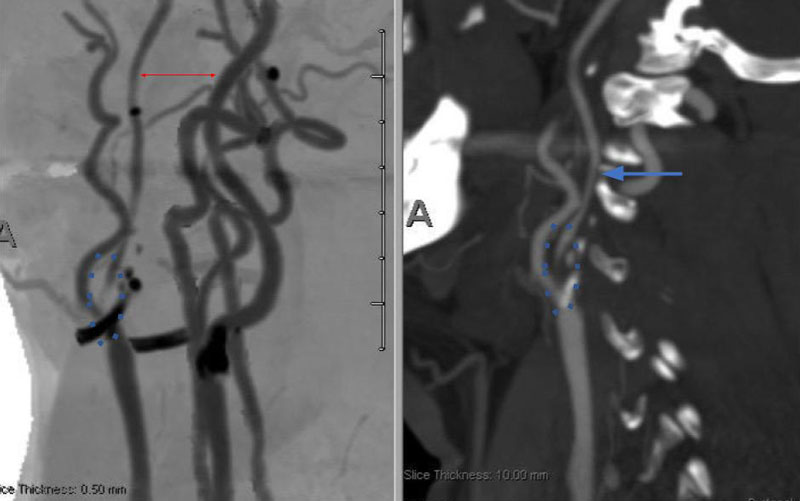 Symptomatic Near-Occlusion of the Carotid Artery | NSPC Brain & Spine ...
