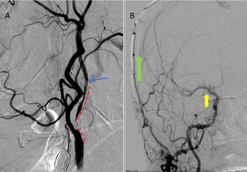 Symptomatic Near-Occlusion of the Carotid Artery | NSPC Brain & Spine ...