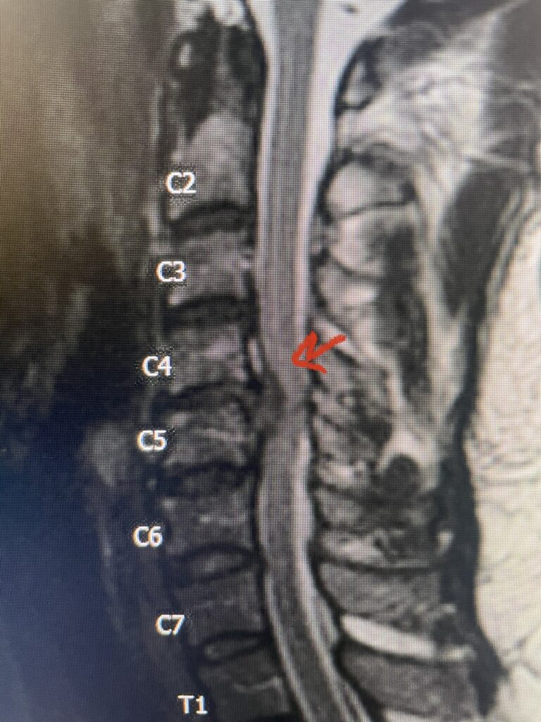 Thecal Sac Cervical Spine
